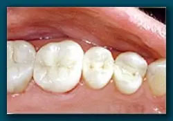 Mercury-Free Fillings in South Lake Tahoe, CA | Tahoe Dentist