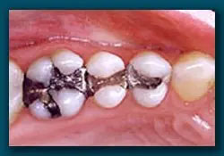 Mercury-Free Fillings in South Lake Tahoe, CA | Tahoe Dentist