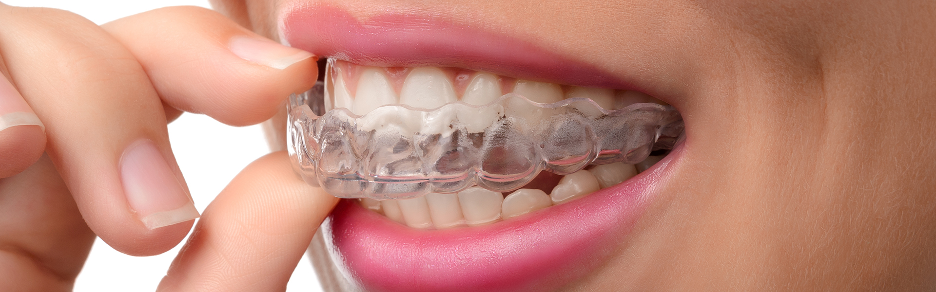 How Long Does Invisalign Take? Your Timeline Explained